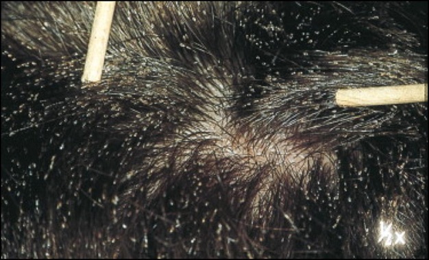 Le ministère de l’Education nie la propagation de pédiculose - Kapitalis